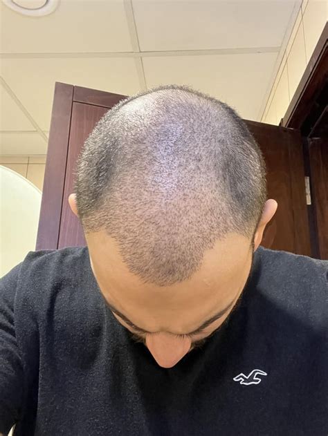 Day 22 Post Operation Density Rhairtransplants