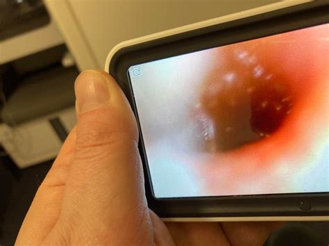 Is This Wax Sitting On The Eardrum Raudiology