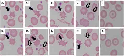 A Thorny Matter Spur Cell Anemia Annals Of Hepatology