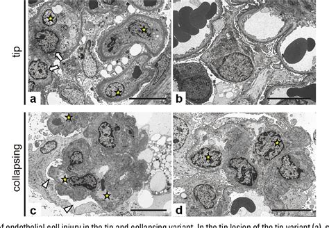 Figure 2 From Diverse Alterations Of Glomerular Capillary Networks In
