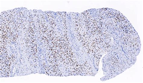Pathology Outlines Sox10