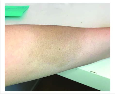 Picture Of The Skin Staining 5 Months After The Extravasation