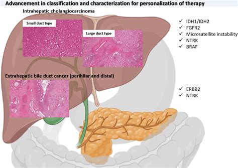 Cholangiocarcinoma Diagram Cholangiocarcinoma Diagram