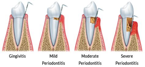 Mild Periodontitis