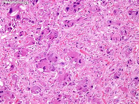 Pheochromocytoma Surgical Treatment