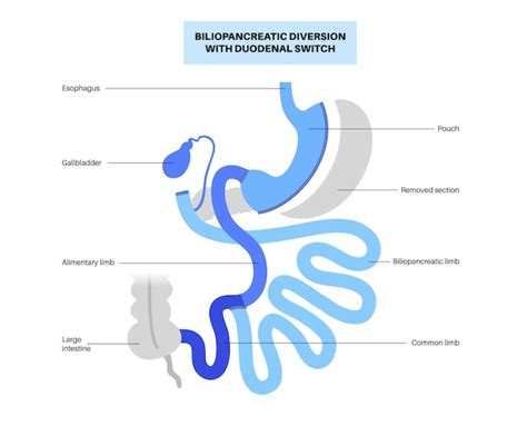 Duodenal Switch Gastric Sleeve Surgery Vs Duodenal Switch Choose The