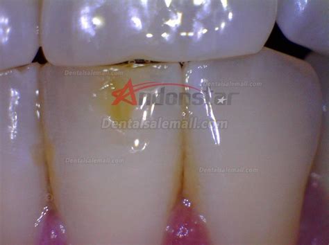 Digital 2mp Usb Pen Microscope Magnifier Endoscope Video Otoscope