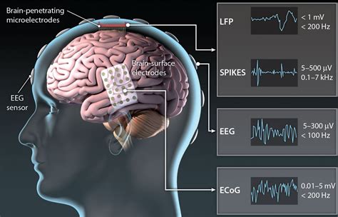 Neural Prosthesis Uses Brain Activity To Decode Speech News IQ Research And Education