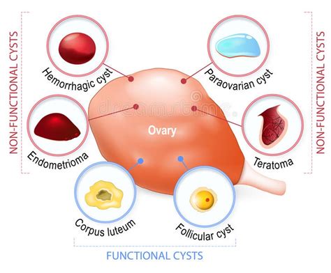 Pre Menopausal Ovarian Cysts What Causes Them How Theyre