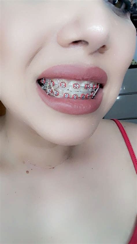 Brakets Color Rojo Ligas Para Brackets Dientes Con Brackets Frenillos Dentales