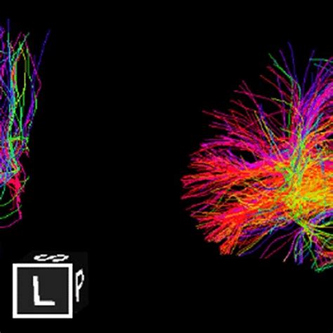 Example Of Anterior Corpus Callosum Section Tractography The Letters Download Scientific