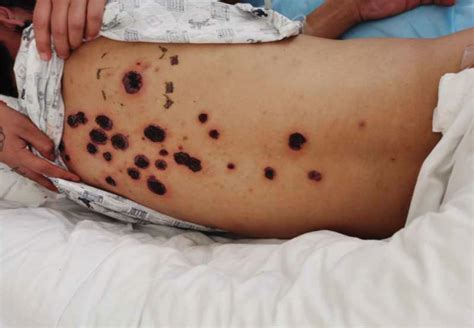 Pyoderma Gangrenosum Complicated With Hematological Malignancies Two Case Reports Pmc