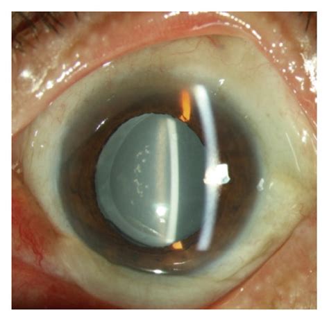 Photographs Of The Distinct Case Of Iol Opacification Ae The
