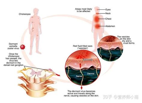 史上最全篇！得了带状疱疹怎么办？ 如何治疗？打疫苗有没有用？看完这篇全明白！ 知乎