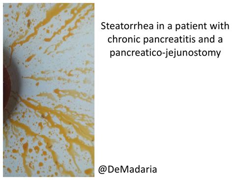200以上 Exocrine Pancreatic Insufficiency Symptoms Mayo Clinic 642909