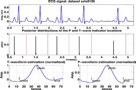 Figure 2 From P And T Wave Delineation In Ecg Signals Using A Bayesian Approach And A Partially