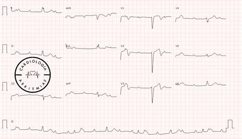 Flutter Auricular Ecg 2025