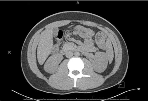 Computed Tomographic Scan Of The Abdomen Prior To Therapy Without