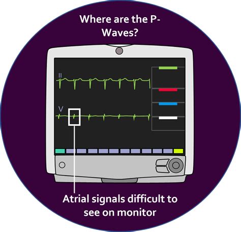 Atrility Medical Improving Access To The Atrial Electrogram