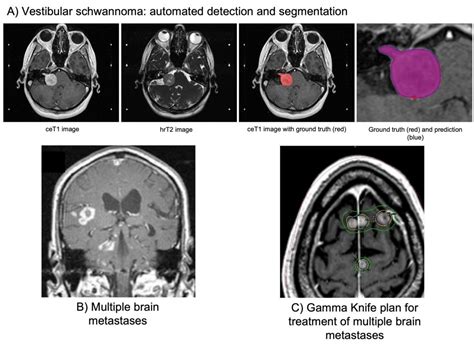 Artificial Intelligence Driven Radiosurgery Planning For Brain