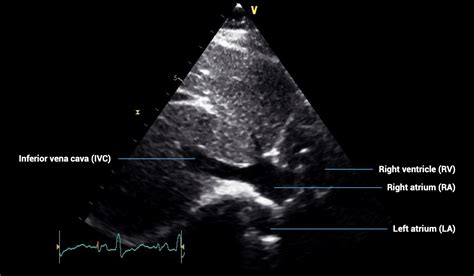 Echo Basics Apical And Subcostal Views • Litfl • Radiology Library