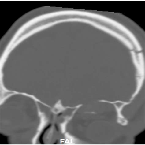 3d Maxillofacial Reconstruction Showing Multiple Left Sided Calvarial Download Scientific