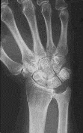 Ulnocarpal Abutment Syndrome Hand Orthobullets
