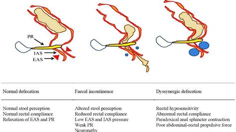 Overflow Incontinence Stool At Anthony Griggs Blog