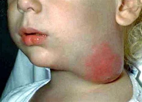 Adenitis Definition Of Adenitis