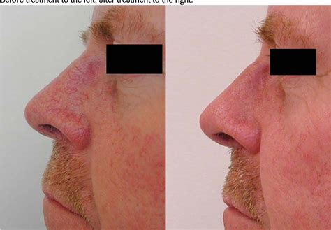 Figure 1 From The Effect On Telangiectasias Of The Nose With A Novel