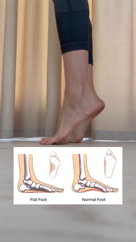 What Makes Flat Feet Dangerous Artofit