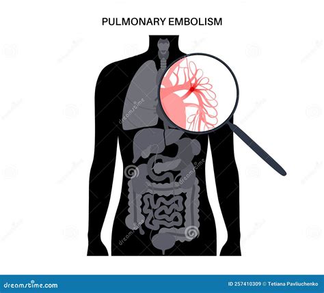 Pulmonary Embolism Disease Cartoon Vector 257410309