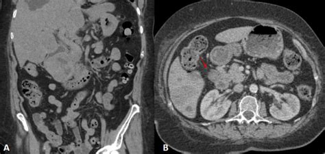 Acoronal Enhanced Ct Image Showing A Duodenal Exophytic Gist A Large Acoronal Enhanced Ct Image Showing A Duodenal Exophytic Gist A Large
