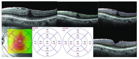example of retinal layer segmentation upper row preoperative images