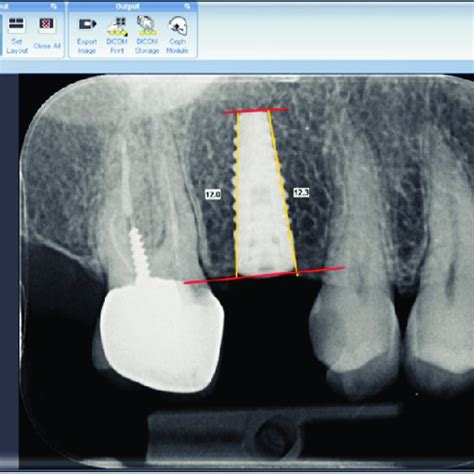 Measurement Of The Bone Crest To The Apex Of The Fixture In Both Mesial