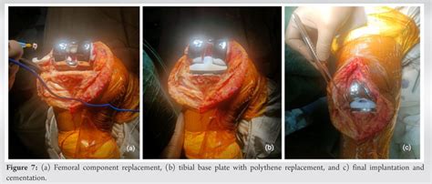 Total Knee Replacement In A Young Patient With Valgus Knee Osteoarthritis A Case Report