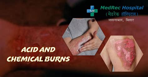 Acid And Chemical Burns A Very Serious Medical Condition