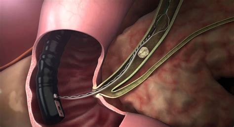 Best Ercp Stenting In Dadar Mumbai By Dr Gajanan Rodge