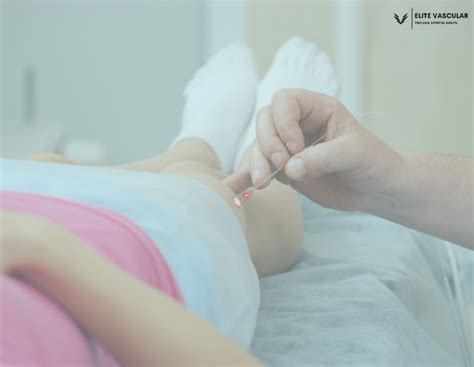 Spider Veins Natural Treatments Help Reduce Spider Veins Appearance