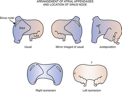 Sinus Node Dysfunction Thoracic Key