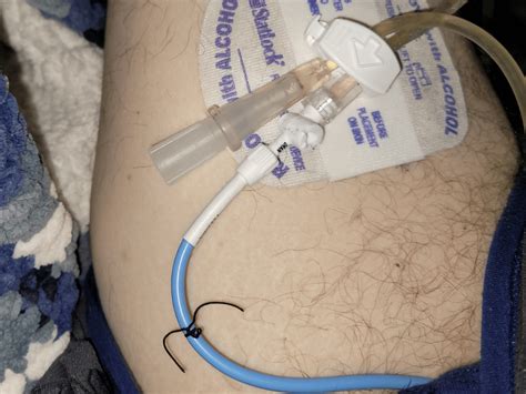 Need Help Identifying A Type Of Supra Pubic Catheter R