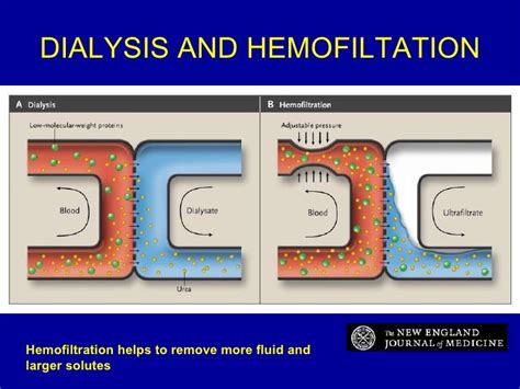 Convection Dialysis At Jett Quong Blog