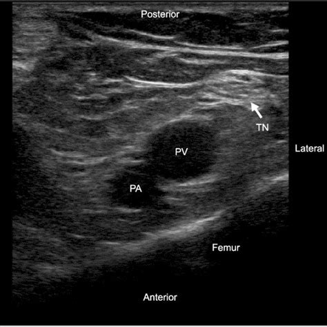 Ultrasound Image For Infiltration Between The Popliteal Artery And