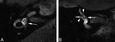 The Nonenhancing Endolymphatic Space A Arrow Occupies 33 Of The