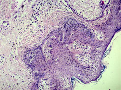 2090172 Nevus With Neoplasms 43 Induction Of Basaloid Prol… Flickr
