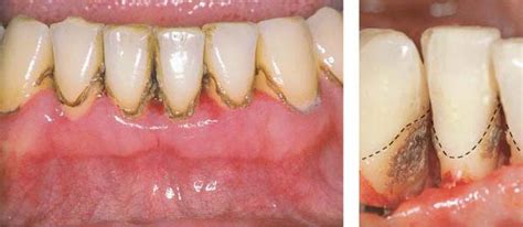 Black Calculus Teeth