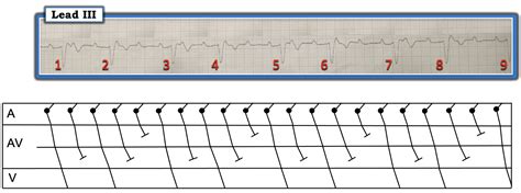 Ecg Interpretation Ecg Blog 347 — Why Non Conducted P Waves