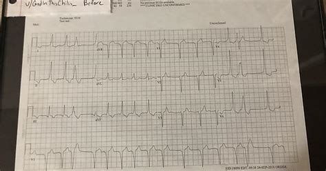 Ekg Scans Of Before And After The Successful Procedure Album On Imgur