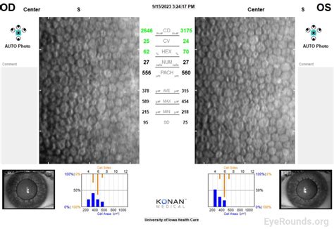 Fuchs Endothelial Corneal Dystrophy From One Medical Student To Another