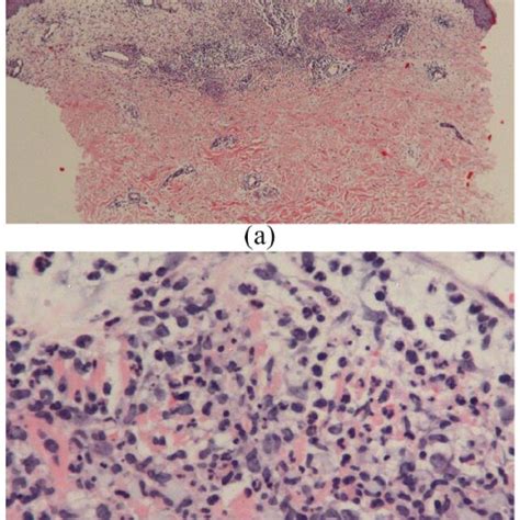 Diffuse Dense Dermal Inflammatory Neutrophilic Infiltrates With Sparse Download Scientific